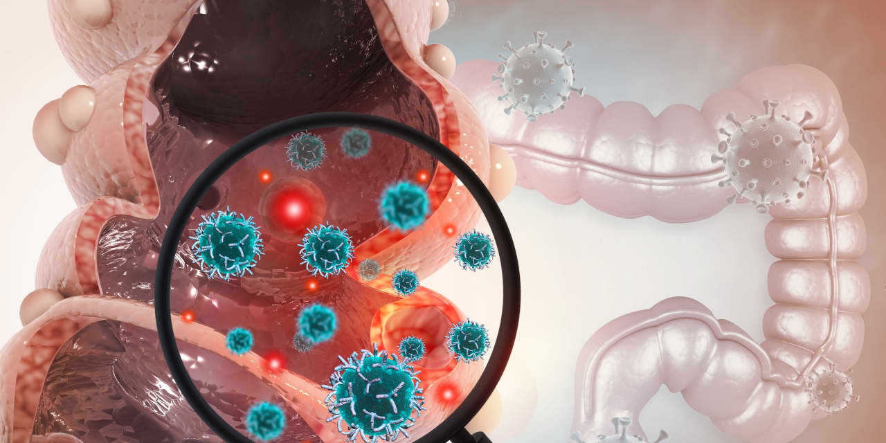 Colon-cancer rates are increasing among people in their 40s — and ...